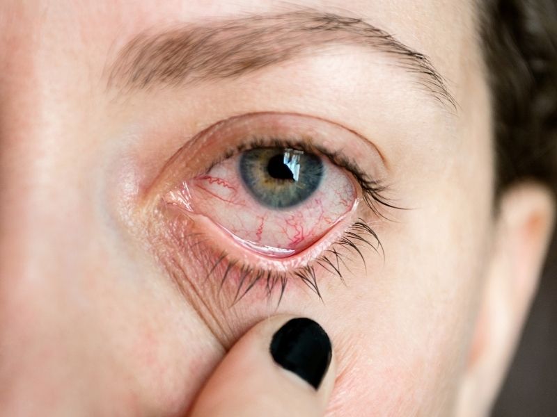 Toksoplazma Üveiti Tedavisi - Ankara Göz Hastalıkları Uzmanı ve Üveit